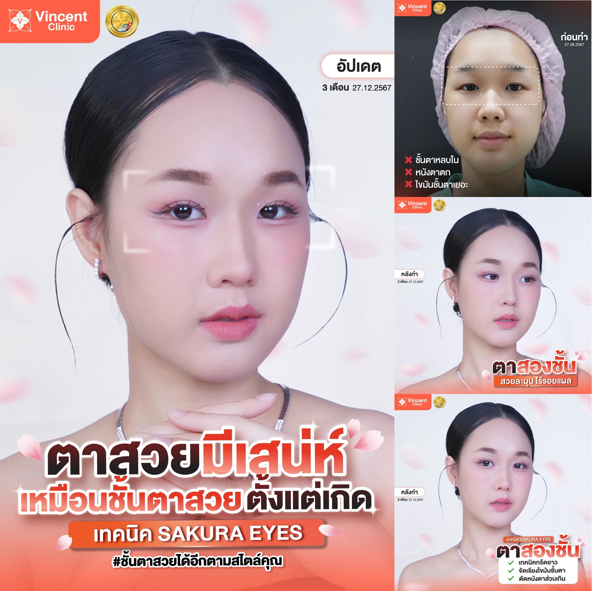 ทำตาสองชั้นที่ไหนดี? เลือกคลินิกให้ปลอดภัยกับ Vincent Clinic