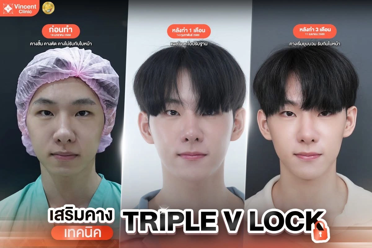 เสริมคางเทคนิค Triple V Lock คืออะไร มีข้อดีอย่างไร ราคาเท่าไหร่ ...